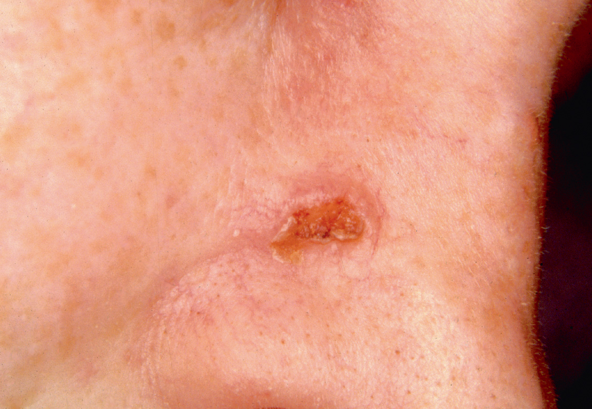 Das variable klinische Bild der Basalzellkarzinome | SpringerLink