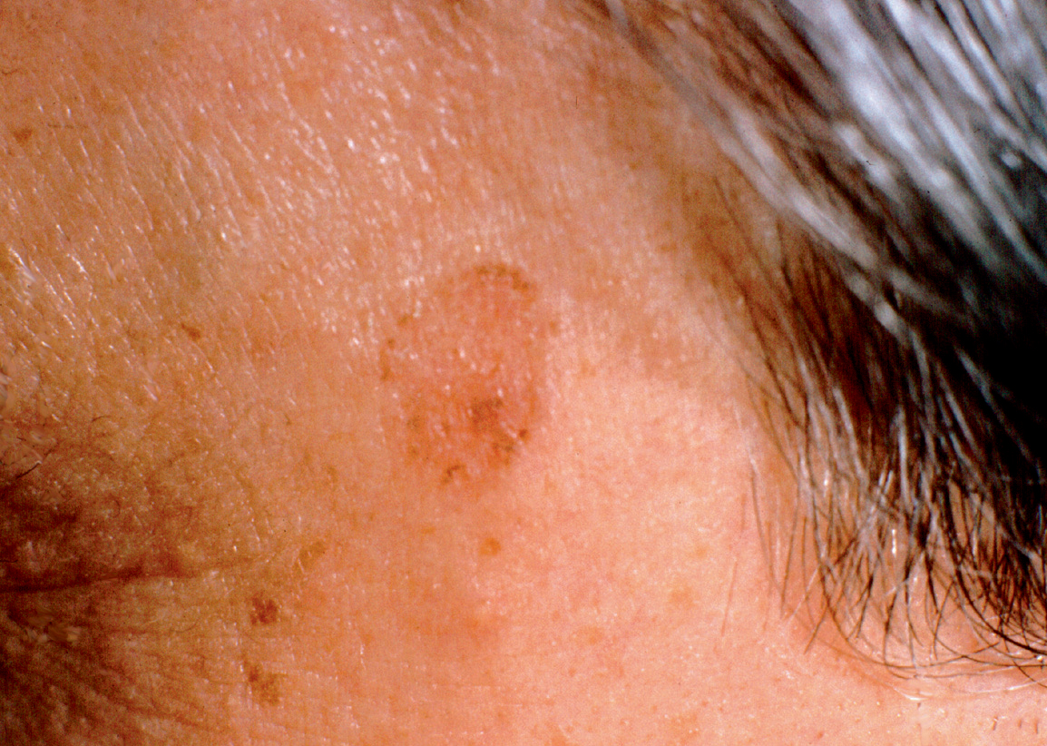 Das variable klinische Bild der Basalzellkarzinome | SpringerLink