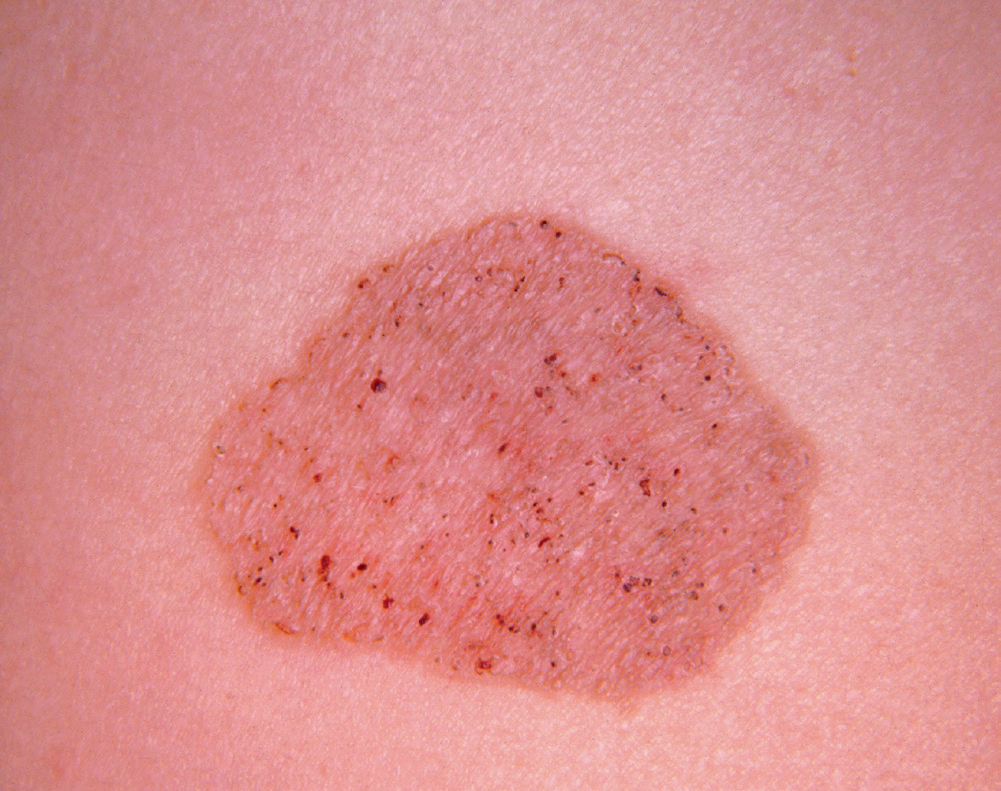 Das variable klinische Bild der Basalzellkarzinome | SpringerLink