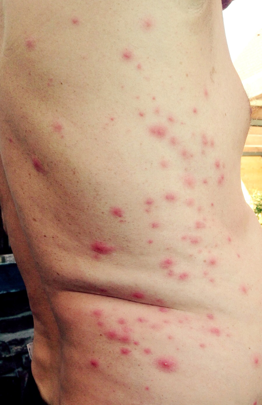 Woher stammen die roten Papeln und Pusteln? | SpringerLink