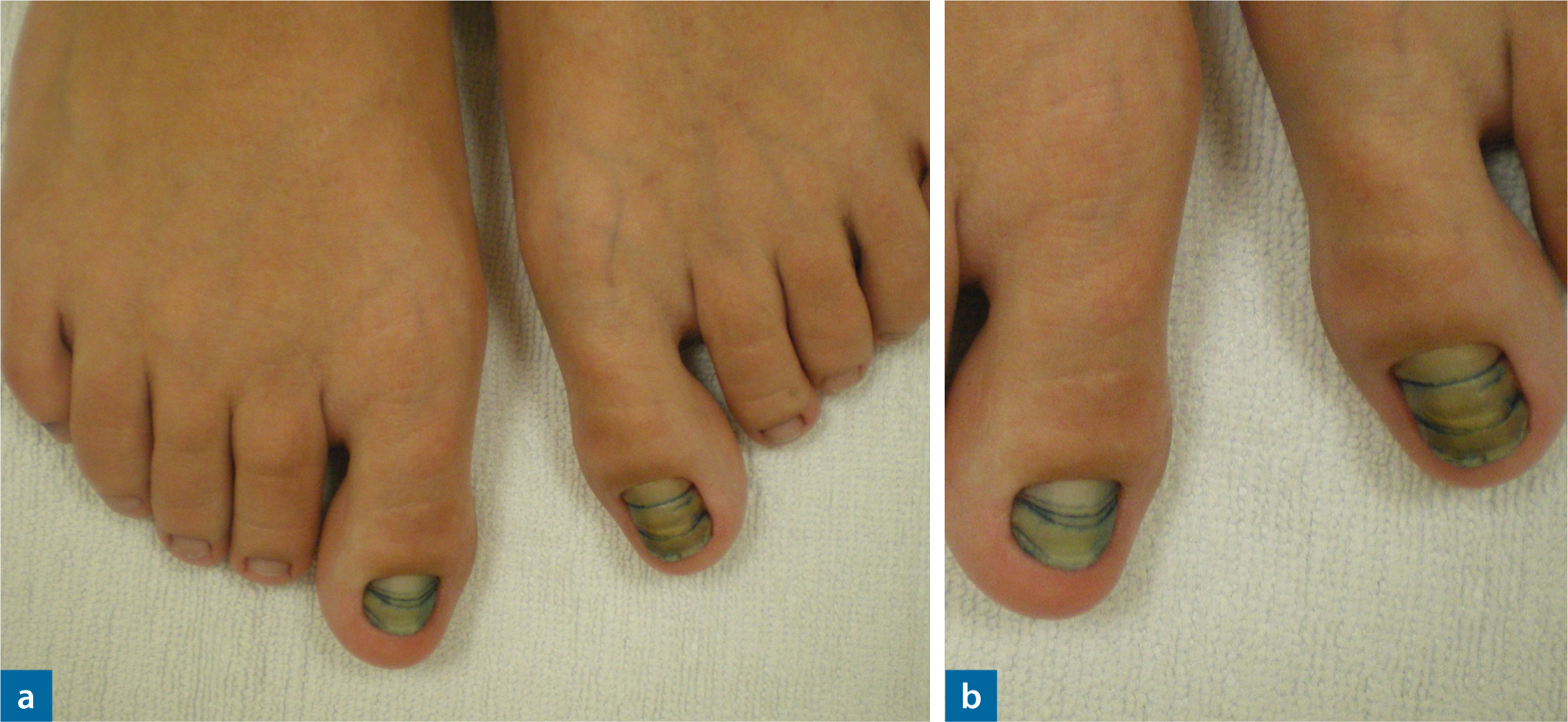 Seltene Spätmanifestation einer Großzehennageldystrophie | SpringerLink