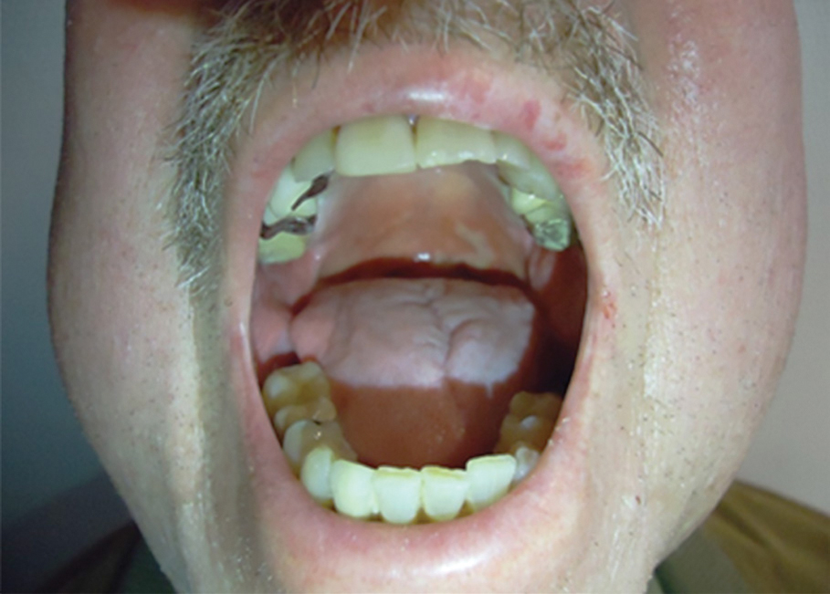 Orale Mukositis durch systemische Tumortherapie | SpringerLink