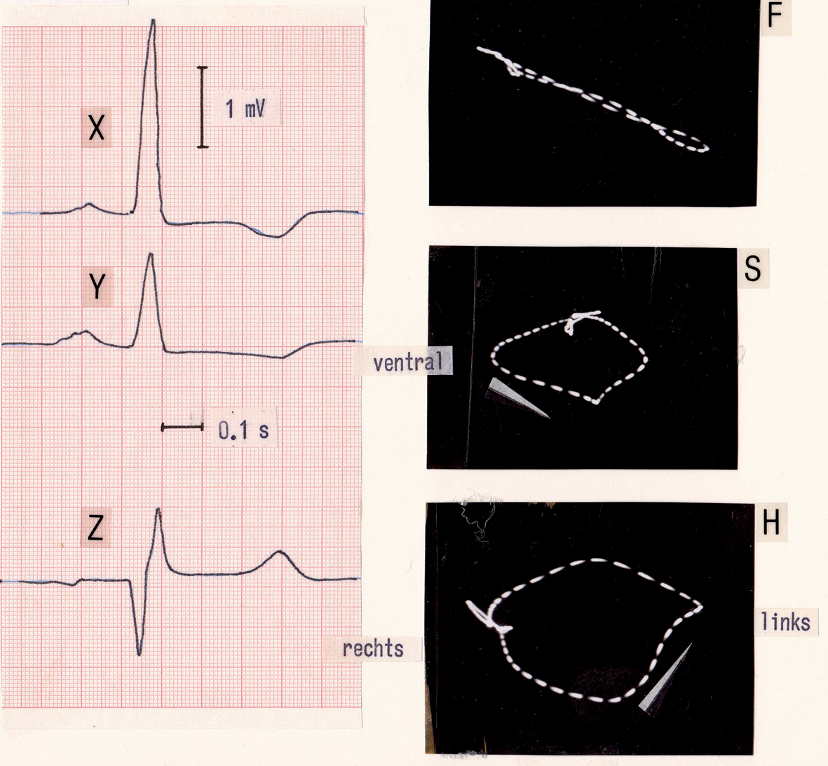 Seltenere Ursachen primärer Repolarisationsstörungen des EKGs ...
