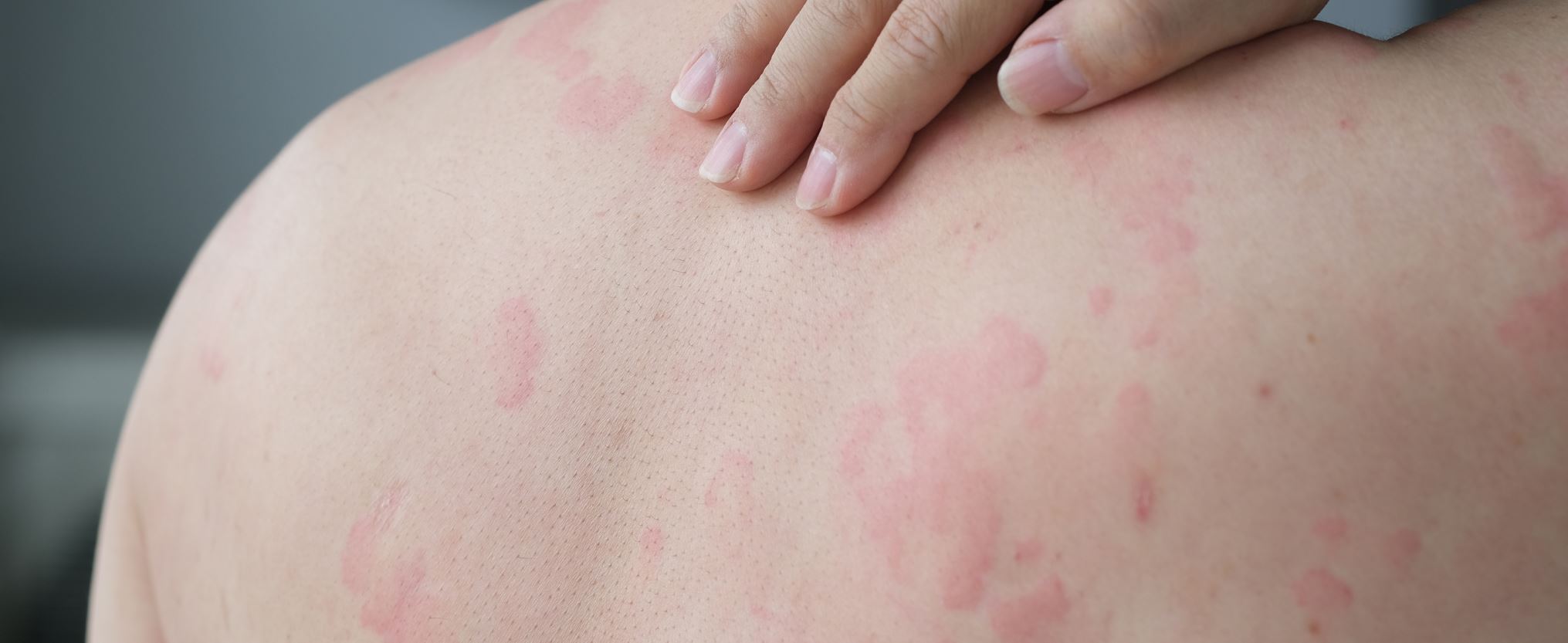 Urtikaria | Unschöne Quaddeln und lästiges Jucken | springermedizin.de