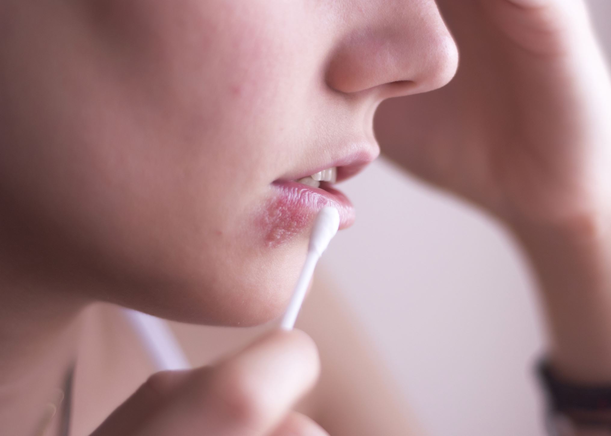 Aphthen | Rund um den Mund | springermedizin.de