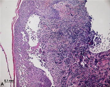 Postoperative Pyoderma Gangrenosum in Association with Renal Cell ...
