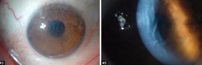 Historical Review and Update of Surgical Treatment for Corneal ...
