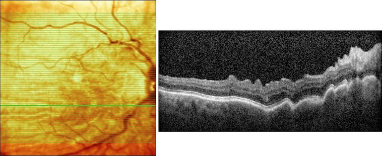 Hypotony Maculopathy: Clinical Presentation and Therapeutic Methods ...