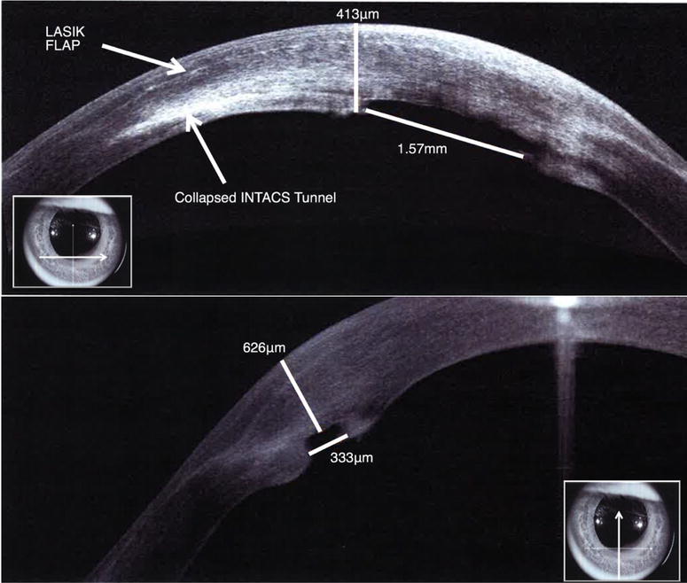 Corneal Hydrops Secondary to Intrastromal Corneal Ring Intrusion into ...