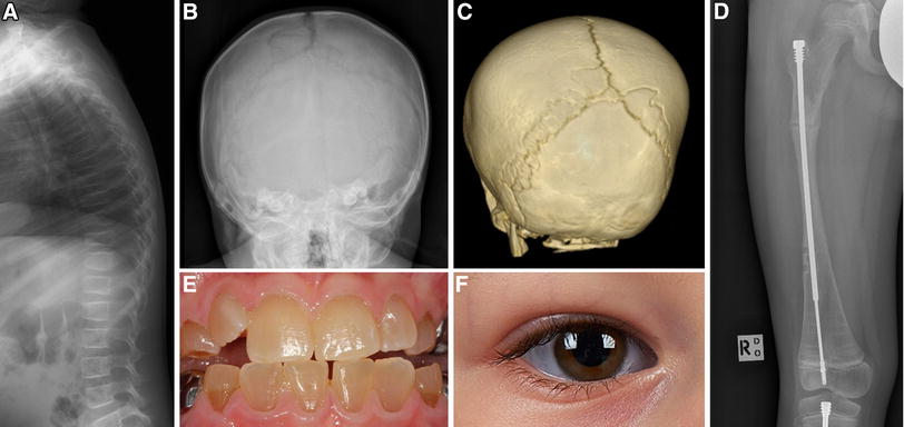 Diagnosis and Management of Osteoporosis in Children | SpringerLink