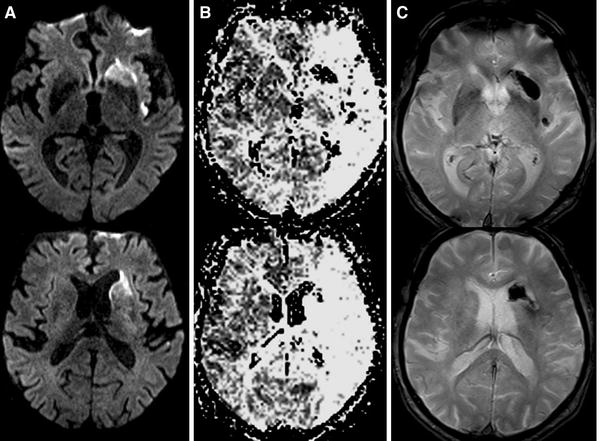 MR Imaging for Acute Stroke | SpringerLink