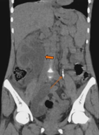 Multidetector CT in Renal Tuberculosis | SpringerLink