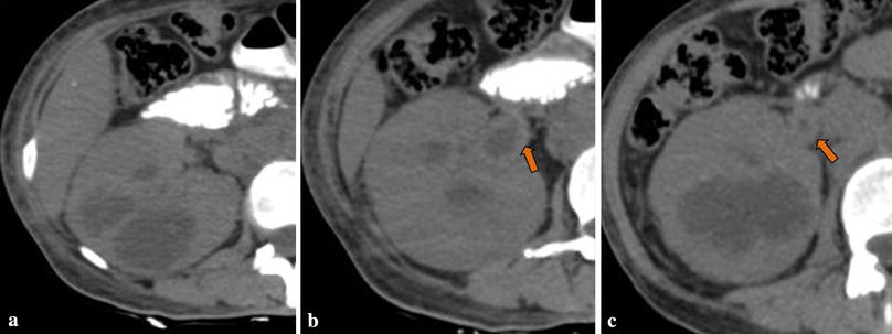 Multidetector CT in Renal Tuberculosis | SpringerLink