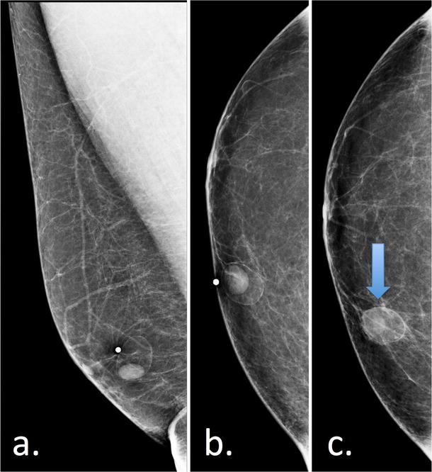 Imaging the Male Breast | SpringerLink