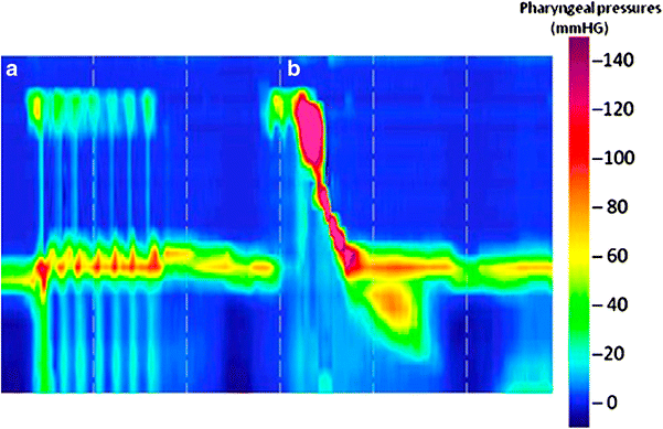 Continued Relevance of Videofluoroscopy in the Evaluation of ...
