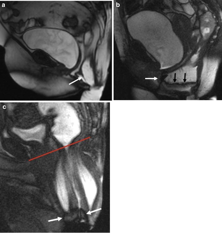 Magnetic Resonance Imaging of Female Pelvic Floor Dysfunction: A Review ...
