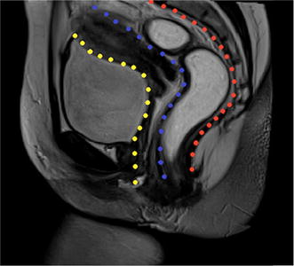 Magnetic Resonance Imaging of Female Pelvic Floor Dysfunction: A Review ...