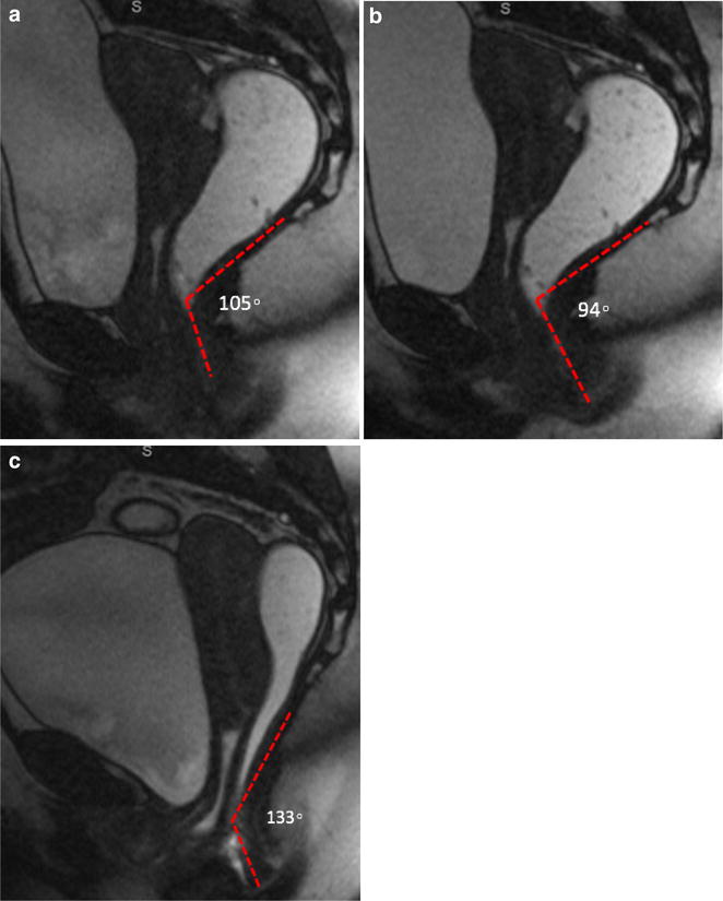 Magnetic Resonance Imaging of Female Pelvic Floor Dysfunction: A Review ...