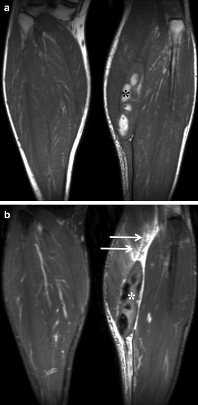 MRI of Sports Injuries in the Leg | SpringerLink