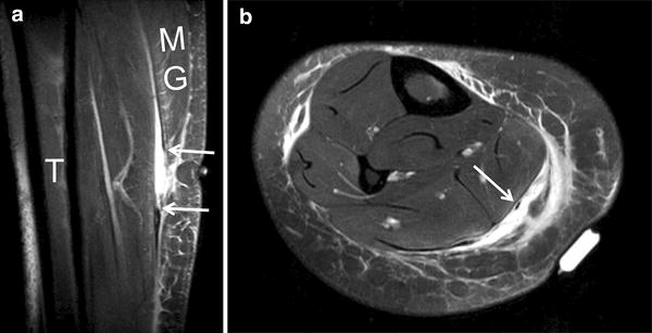 MRI of Sports Injuries in the Leg | SpringerLink
