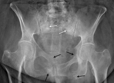 Fragility Fractures of the Pelvis: New Approaches to Classification and ...
