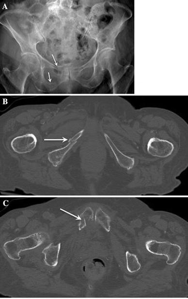 Fragility Fractures of the Pelvis: New Approaches to Classification and ...