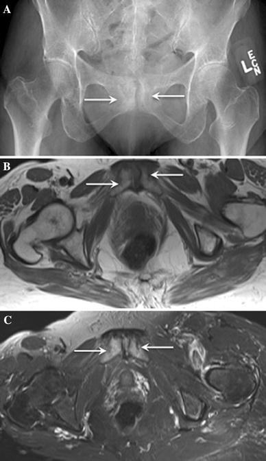 Fragility Fractures of the Pelvis: New Approaches to Classification and ...