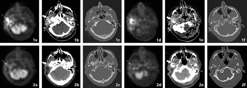 Advanced Imaging Techniques in Skull Base Osteomyelitis Due to ...