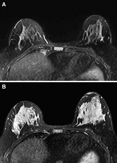 Imaging the Breast in Pregnant or Lactating Women | SpringerLink