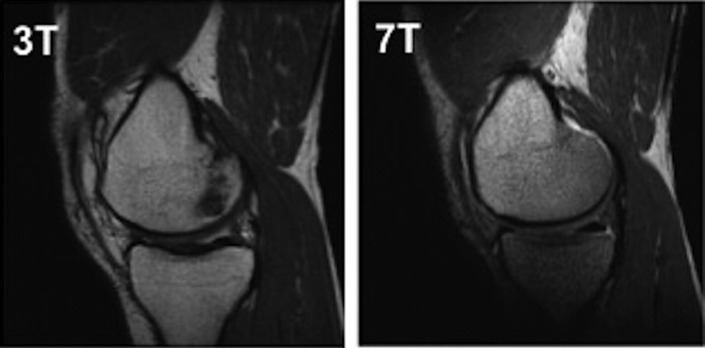 The Emerging Role of 7 Tesla MRI in Musculoskeletal Imaging | SpringerLink