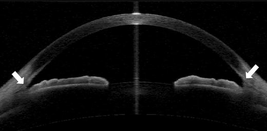 Angle Closure Imaging: A Review | SpringerLink