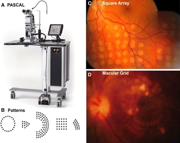New Laser Technologies for Diabetic Retinopathy | SpringerLink