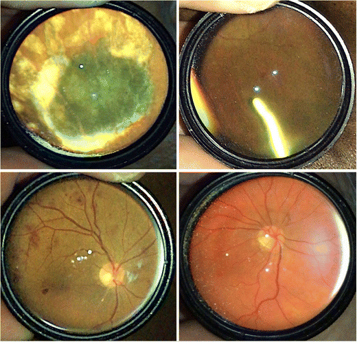 Smartphone Assisted Fundus Fundoscopy/Photography | SpringerLink