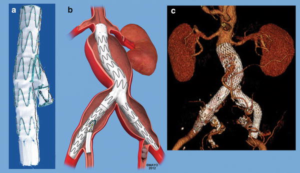 Endovascular Repair of Complex Aortic Pathology | SpringerLink
