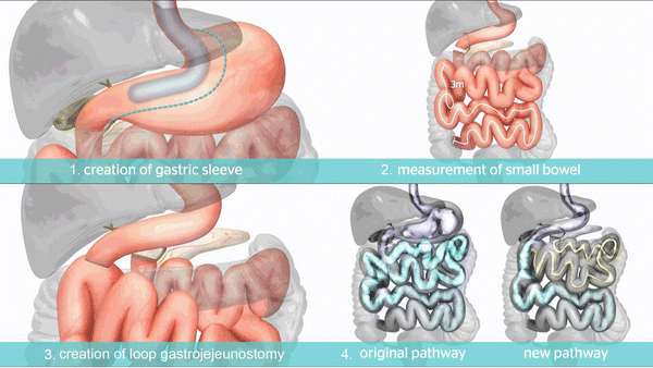 Stomach Intestinal Pyloric Sparing Surgery or SIPS | SpringerLink