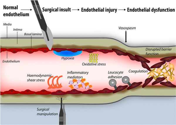 Perioperative Implications of Vascular Endothelial Dysfunction: Current ...