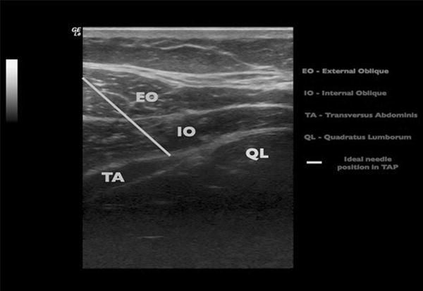 Transversus Abdominis Plane Block | SpringerLink