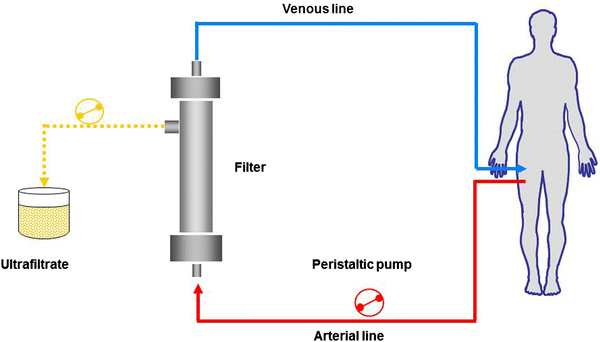 Continuous Ultrafiltration in Acute Decompensated Heart Failure ...