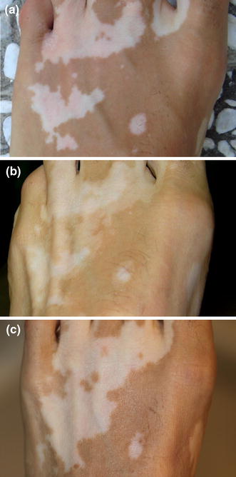 Depigmentation Patterns of Nonsegmental Vitiligo | SpringerLink