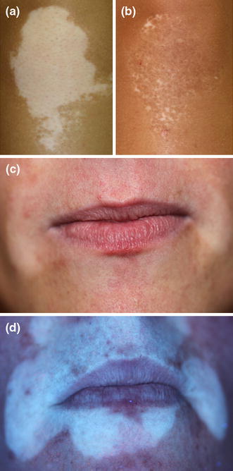 Depigmentation Patterns of Nonsegmental Vitiligo | SpringerLink