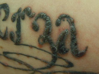 Complications of Decorative Tattoos: Recognition and Management ...