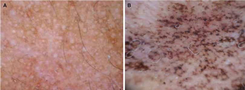Exogenous Ochronosis: A Comprehensive Review of the Diagnosis ...