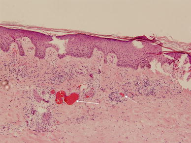 Cryofibrinogenemia-Induced Cutaneous Ulcers: A Review and Diagnostic ...