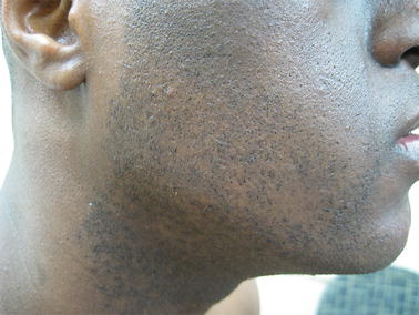 Facial Hyperpigmentation in Skin of Color: Special Considerations and ...