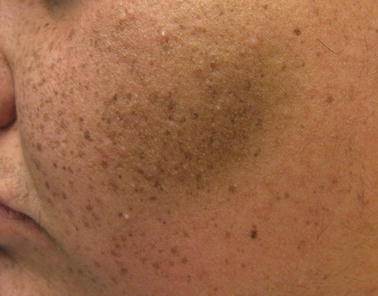 Facial Hyperpigmentation in Skin of Color: Special Considerations and ...