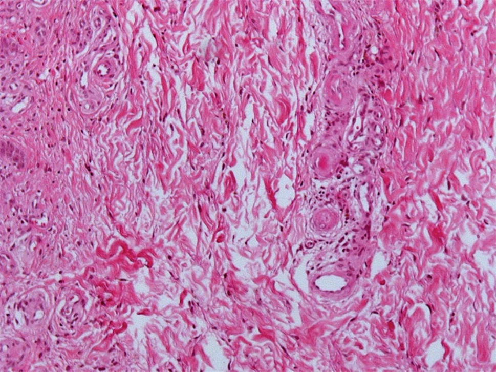 An Update on Calciphylaxis | SpringerLink