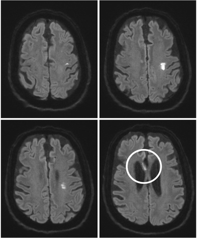 Management of Embolic Stroke of Undetermined Source (ESUS) | SpringerLink