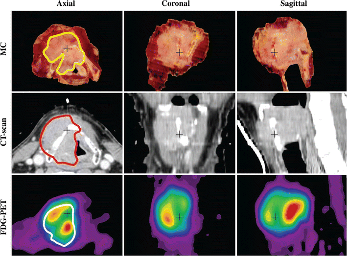 Pathology-validated PET image data sets and their role in PET ...