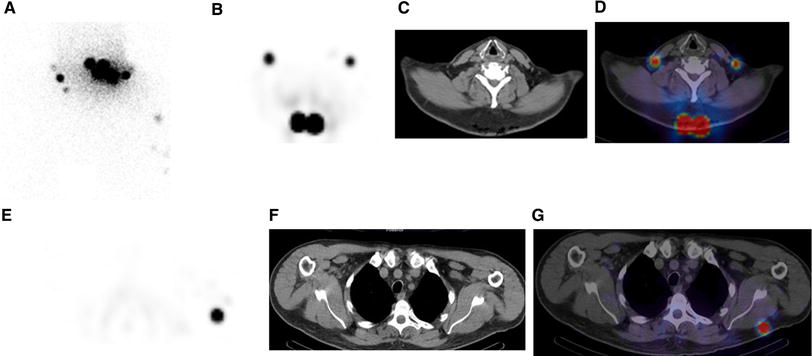 SPECT/CT in imaging sentinel nodes | SpringerLink