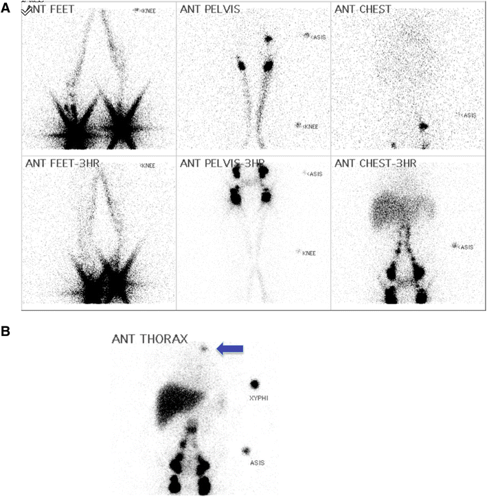 Lymphoscintigraphy in paediatric and adolescent patients | SpringerLink